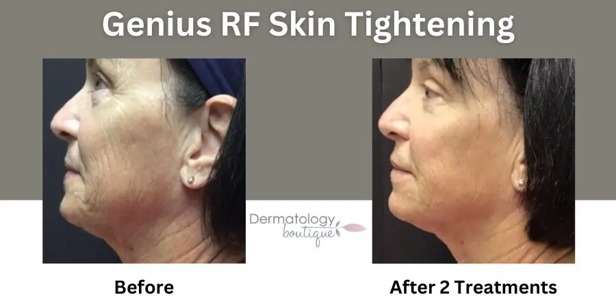 Morpheus vs Genius Radiofrequency Microneedling